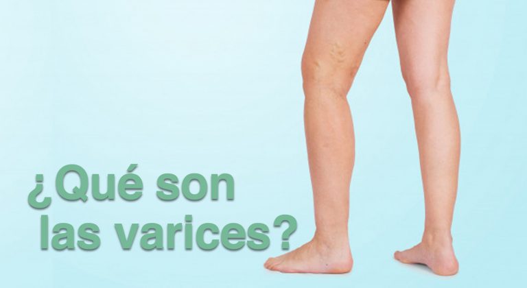 QUÉ ES BUENO PARA LAS VARICES 】