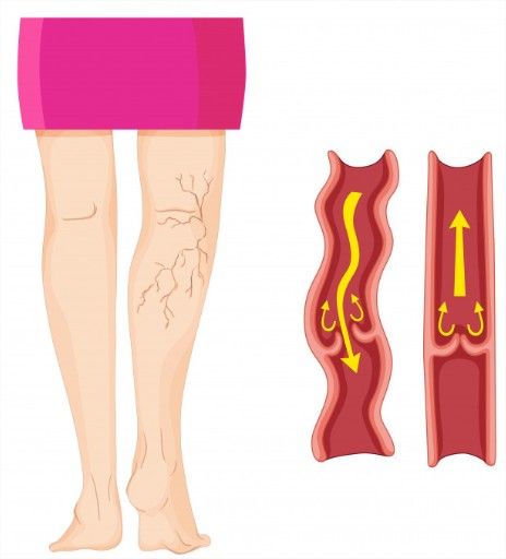 Tratamiento de varices sin cirugía 】 Diagnóstico y precio