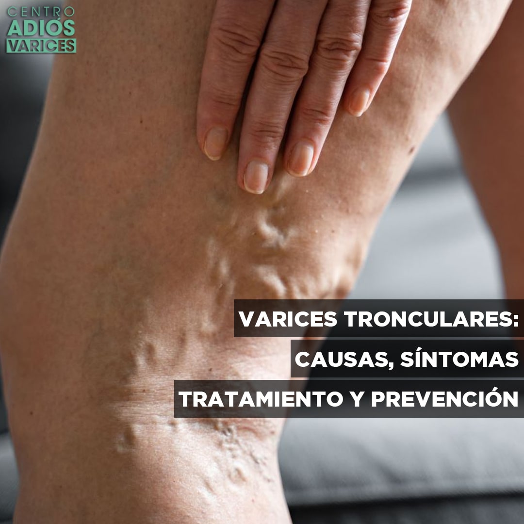 VARICES TRONCULARES 】 SÍNTOMAS Y PREVENCIÓN