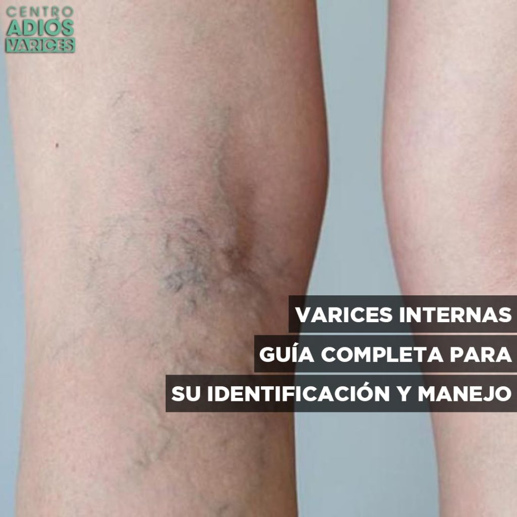 VARICES INTERNAS 】 IDENTIFICACIÓN Y MANEJO